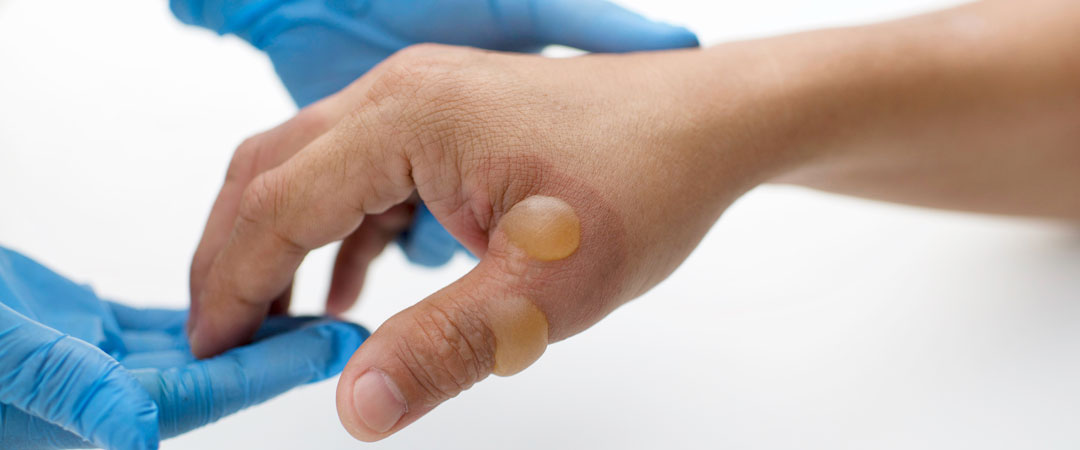 Φουσκάλα από κάψιμο στο χέρι | Tips Φροντίδας - meFrontizo.gr